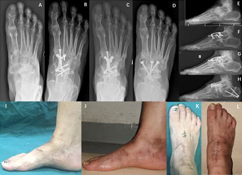 Patient No 3 A C Weight Bearing Ap X Ray Films Before The Operation
