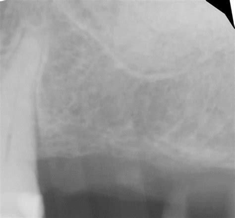 Paradigm Shift Sinus Augmentation With Sinus Membrane Removal