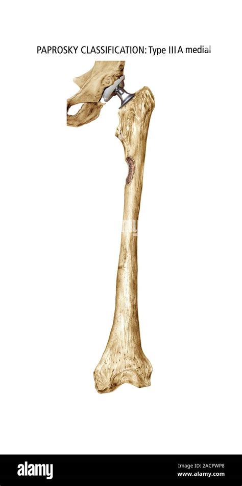 Paprosky Femur Defect Artwork Of Bone Degradation In A Type Iiia