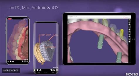 Beyond Imaging 3d Digital Wax Up And Digital Provisionals