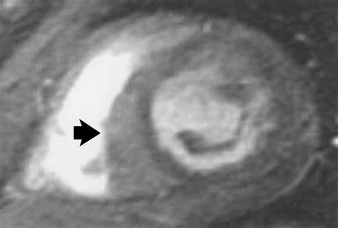 A Unique Presentation Of Cardiac Sarcoidosis Ajr