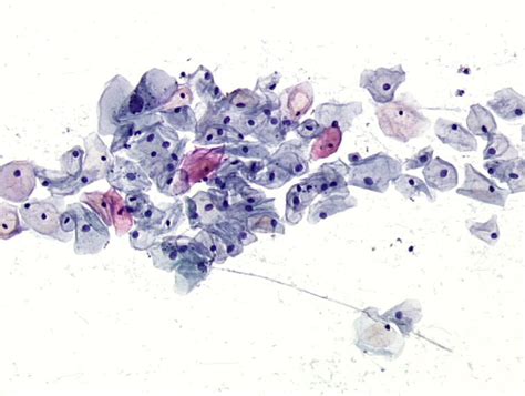 子宫颈组织病理学和细胞病理学 数字图谱 细胞病理学