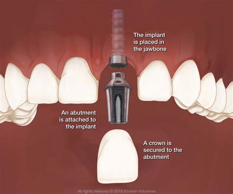 Dental Implants Bountiful Ut Layton Ut Murray Ut Implant