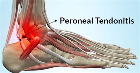Tendinopatia Dos Tendões Fibulares