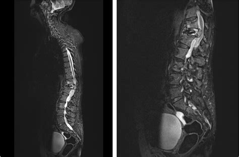 Osteoporotic Fracturesposterior Long Segment Fixation T8 L3dr Med