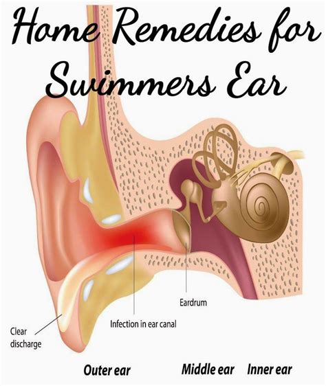 The 25 Best Swimmers Ear Ideas On Pinterest Swimmers Ear Remedies