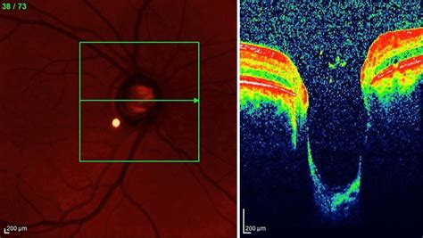 An Oct Normal Od Subject Left The Onh Cup And Its Surroundings The