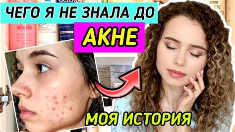 АКНЕ О ЧЁМ НЕ ГОВОРЯТ Моя история лечения прыщей Youtube