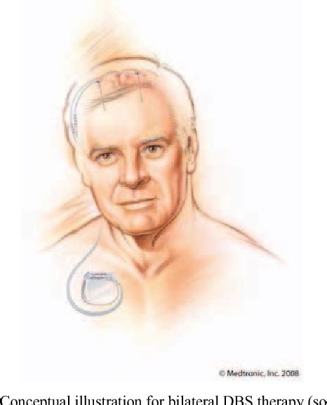 Figure 1 From A New Biomarker For Closed Loop Deep Brain Stimulation In