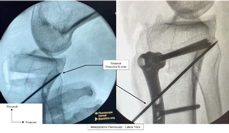 Figure 5 From Anterior Closing Wedge High Tibial Osteotomy Using