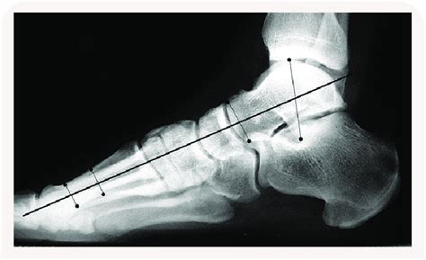 Normal Weight Bearing Lateral View Talus Rst Metatarsal Angle The
