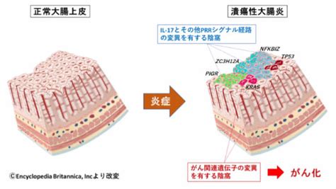 潰瘍性大腸炎の慢性罹患で大腸がんの発症率が上がる 潰瘍性大腸炎とクローン病のまとめブログ
