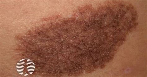 Congenital Naevus Image Congenital Naevus Image