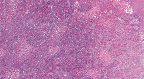 Squamous Cell Carcinoma Of The Oral Cavity Atlas Of Pathology