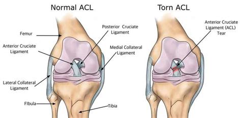 What Can Be Done For An Acl Tear Acl Tear Surgery At Jaipurjoints