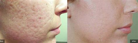 Laser Genesis — H Med Spa In Wicker Park