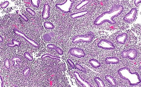 Disordered Proliferative Endometrium Mypathologyreport