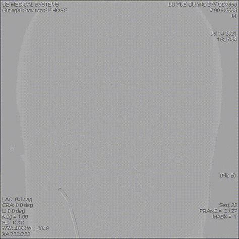 中枢介入第362期：侧窦区硬脑膜动静脉瘘 压力锅技术治愈栓塞 脑医汇 神外资讯 神介资讯
