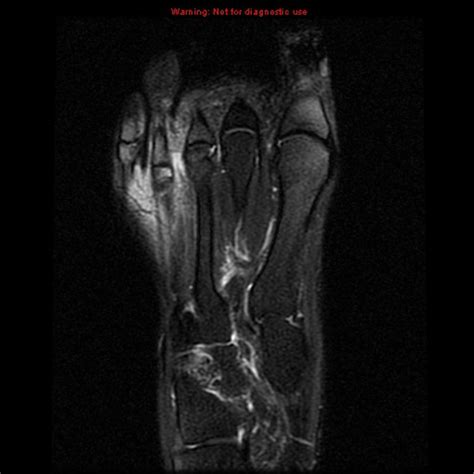 Iliotibial Bursa 9 Tips To Self Treat Hip Bursitis Side Of The Hip