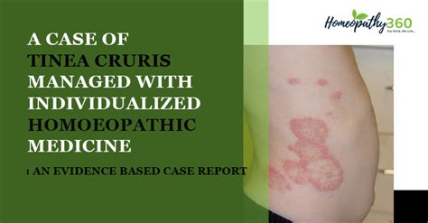 Jock Itch Tinea Cruris Causes Risk Factors Signs