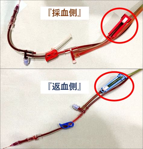 末梢血幹細胞採取時における緊急輸液の手順（optia®の場合） 遠心分離アフェレーシス技術フォーラム