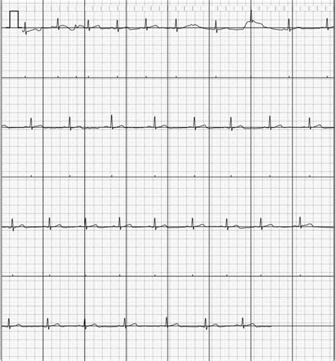 Could It Be Afib Rafib