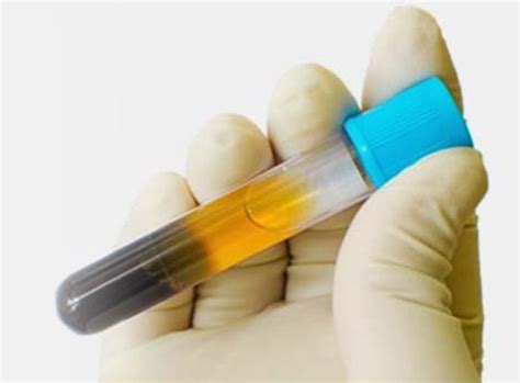 Learn About Specimen Integrity In This Article Cardinalhealth