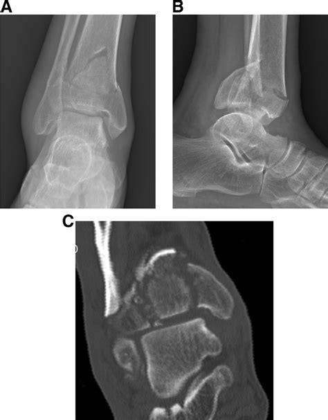 A Plain Radiographic Anteroposterior And B Lateral Views And C