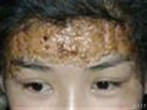 老鼠疮最严重图片 老鼠疮的症状图 伤感说说吧