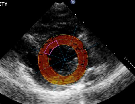 Can I Automatically Find Circle Donut Shape And Do Automatic Segmentation In Imagej For Roi