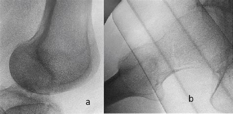 Figure 6 From Rotational Malalignment In Femoral Nailing Prevention