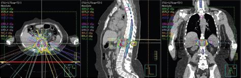 Stereotactic Radiosurgery For Tumors Of The Spine Neupsy Key