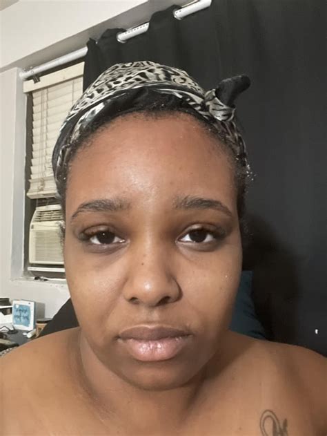 Urticaria And Angioedema 😩 Rurticaria