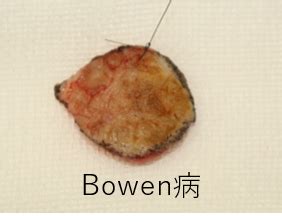 ボーエン病Bowens disease 治療経過 医療法人 双英会 YUKI皮フ科形成外科一宮市時之島の皮膚科形成外科