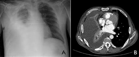 Initial Chest Radiograph A And Ct B Showing A Large Loculated