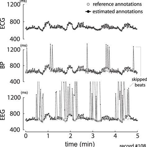 Comparison Of Ecg Bp And Eeg Detection Quality For Signals With A