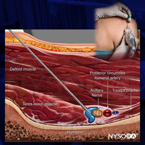 Ultrasound Guided Axillary Nerve Block Osama El Fadil