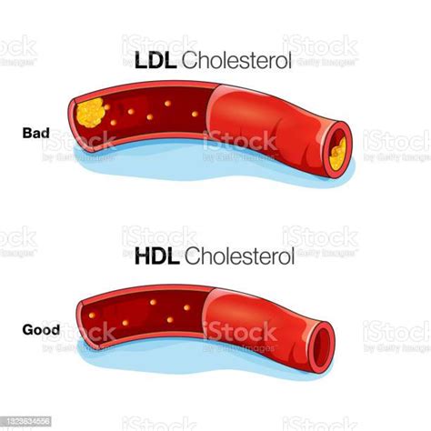 플라크를 형성하는 측 혈관에서 저밀도 지단백 또는 Ldl 및 고밀도 지단백의 그림 0명에 대한 스톡 벡터 아트 및 기타 이미지