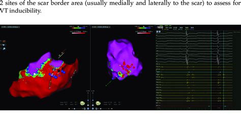 Intraprocedural Carto Three Dimensional Left Ventricular Epicardial