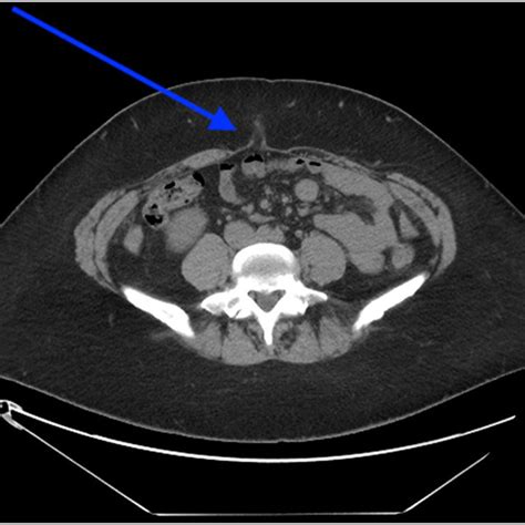 Ct Scan Axial View Of The Right Upper Quadrant Incisional Hernia Blue