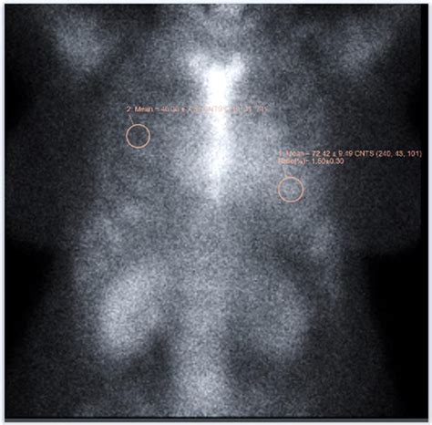 A Positive Pyp Scan Thinking Beyond Amyloid Journal Of Nuclear