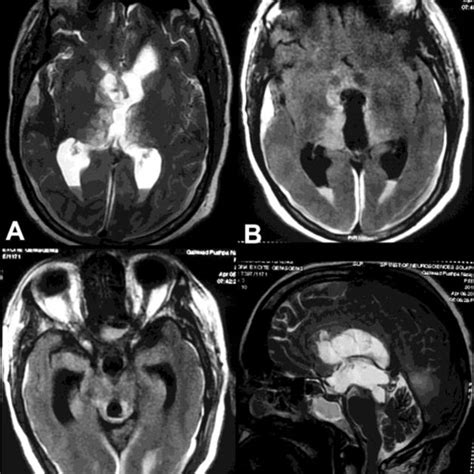 Mri Brain T1w Sagittal Images And T2w Coronal Image Showing The