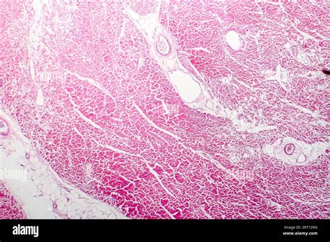 Histopathology Of Bacterial Myocarditis Inflammatory Heart Disease Light Micrograph Stock