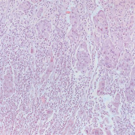 Pdf Histological Grading In Colorectal Cancer New Insights And