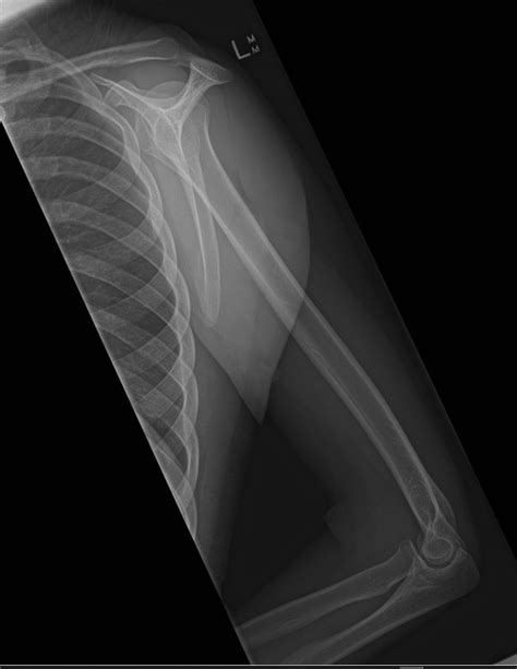 Lateral Humerus X Ray Rit Radiology Medial Epicondyle Fracture Of The