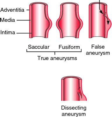 False Aneurysm Definition Of False Aneurysm By Medical Dictionary