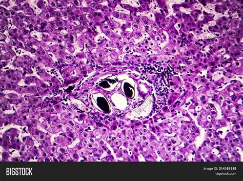 Liver Schistosomiasis Light Micrograph Photo Under Microscope Showing