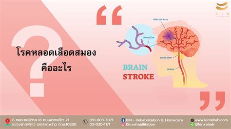 โรคหลอดเลือดสมองคืออะไร