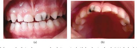 Figure 1 From Fusion Or Gemination Diagnosis And Management In Primary