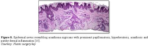 Scitech Verrucous And Inflammatory Epidermal Nevus Journal Of